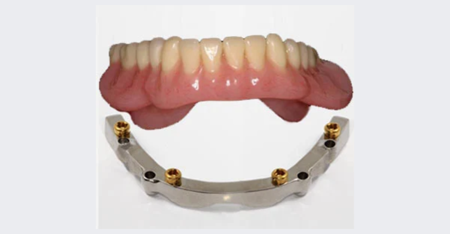 Locator Bar Overdenture — GIE Dental Lab | Los Angeles, CA | #1 in ...