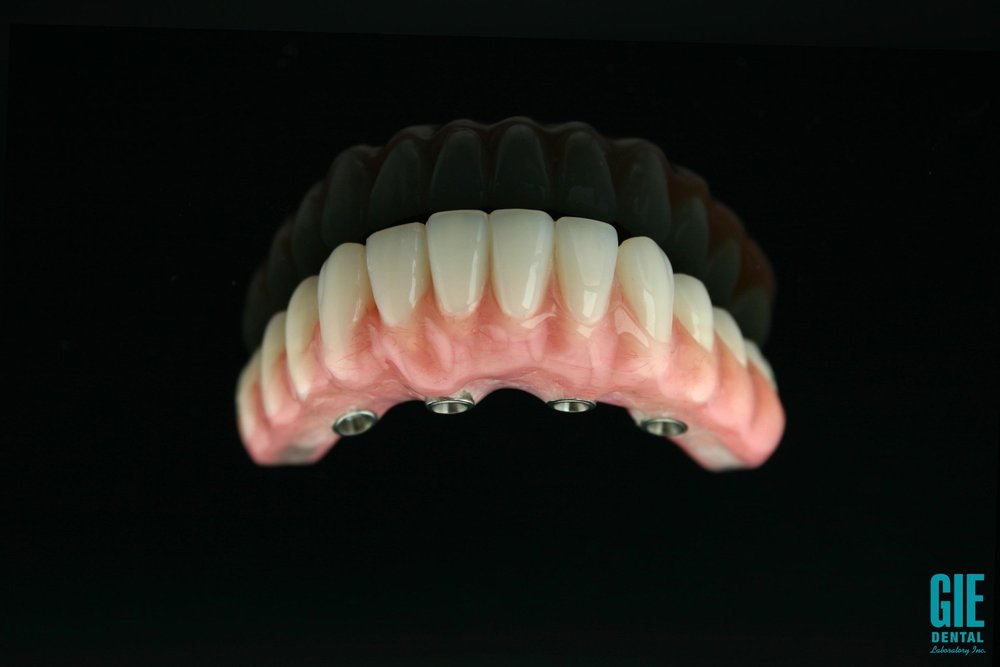 Hybrid Fixed Denture with Substructure | Enhance Your Smile Today ...
