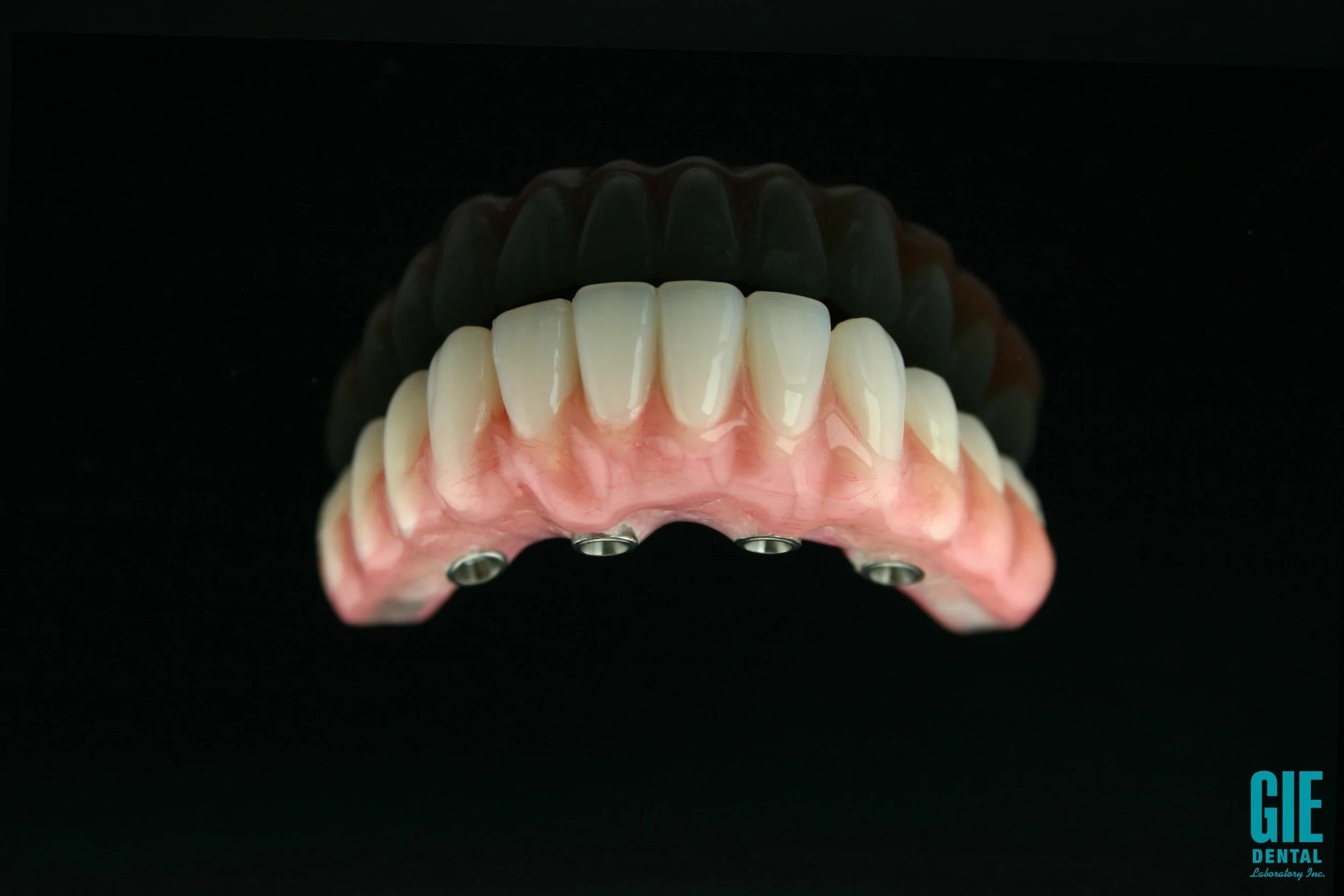 Hybrid Fixed Denture with Substructure | Enhance Your Smile Today ...
