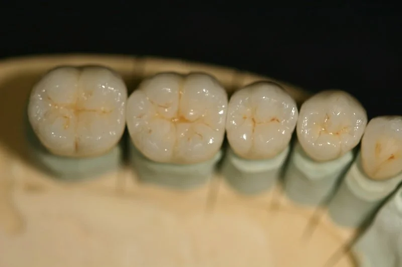 Porcelain Fused to Metal — GIE Dental Lab | Los Angeles, CA | #1 in ...