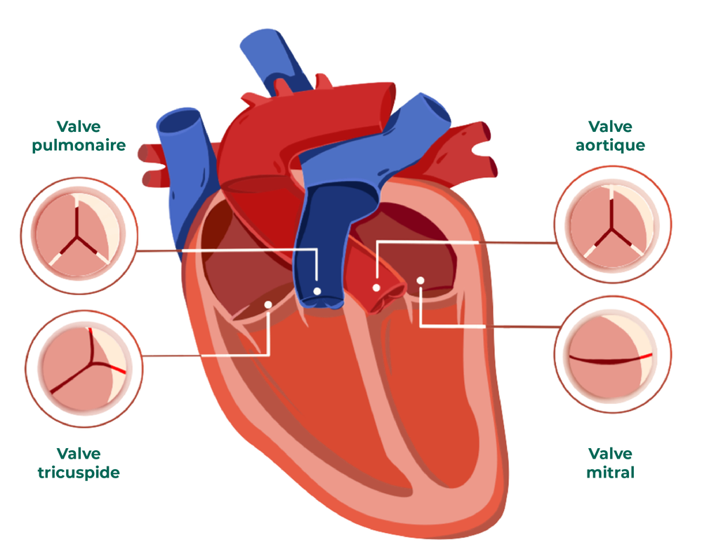 Maladie valvulaire — Heart Valve Voice Canada