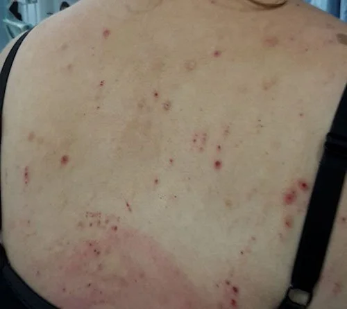 Symptoms — ICP Support