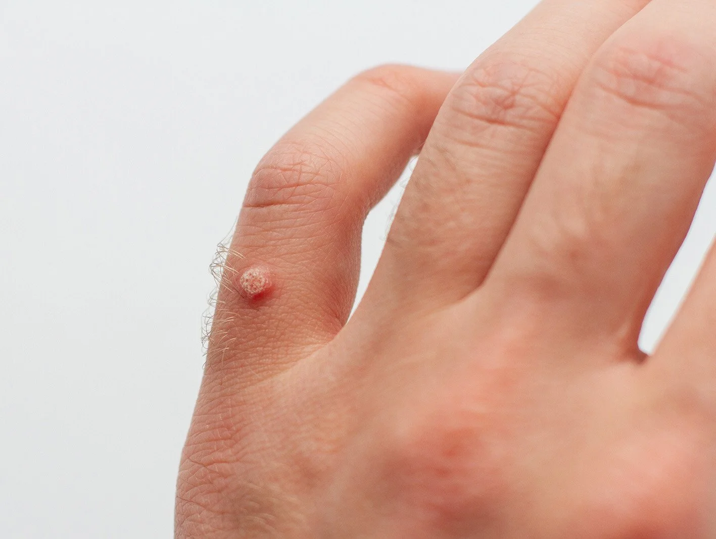 Viral Warts Treatment Sydney — Hunters Hill Dermatology | Sydney Dermatologists | Skin Cancer ...