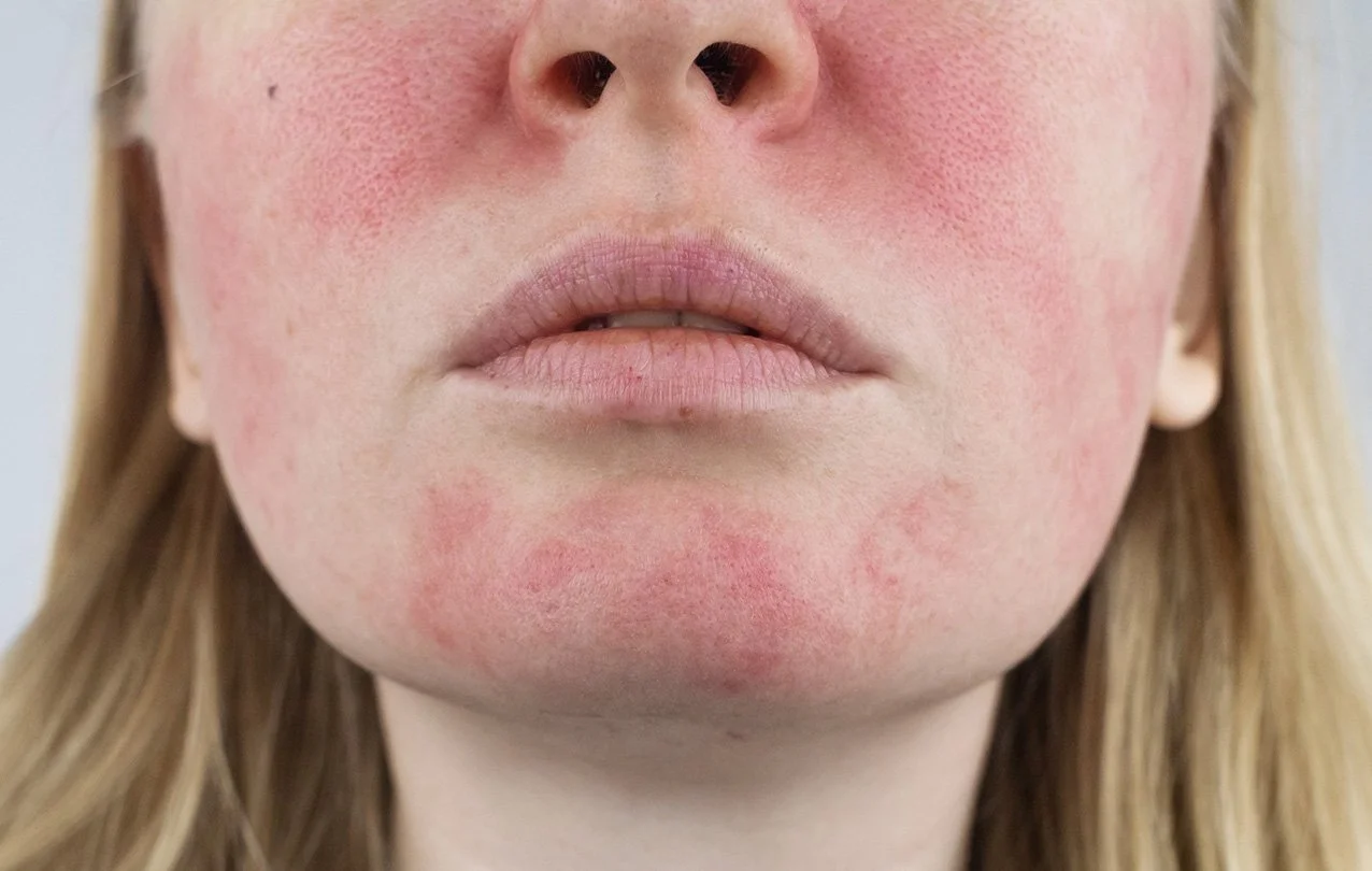 Acne & Rosacea Treatments — Hunters Hill Dermatology | Sydney ...