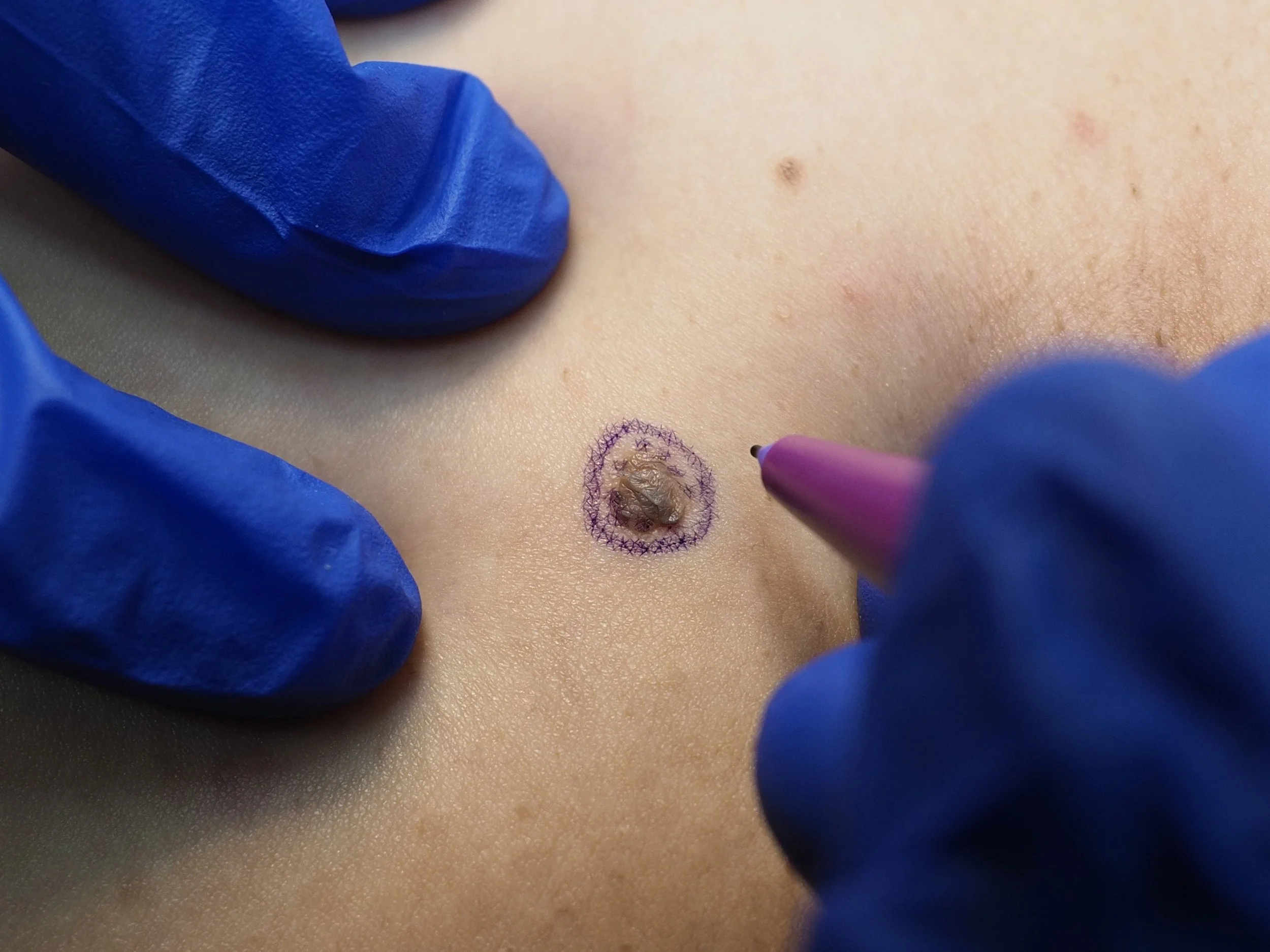 Treatment of Precancerous Lesions Sydney — Hunters Hill Dermatology ...