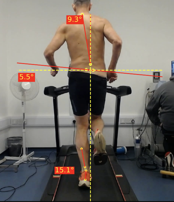 Gait Analysis Liverpool — The treatment table