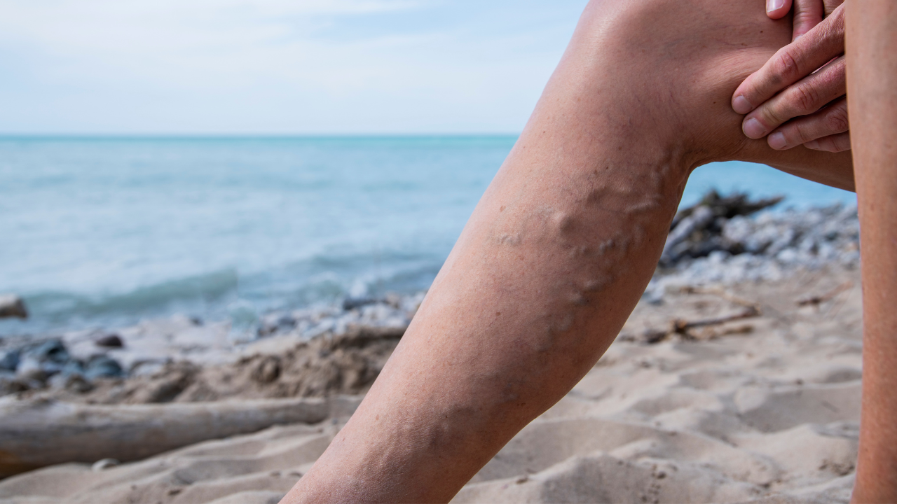 Horse Chestnut Tincture: Your Ultimate Vein & Cardiovascular Ally ...