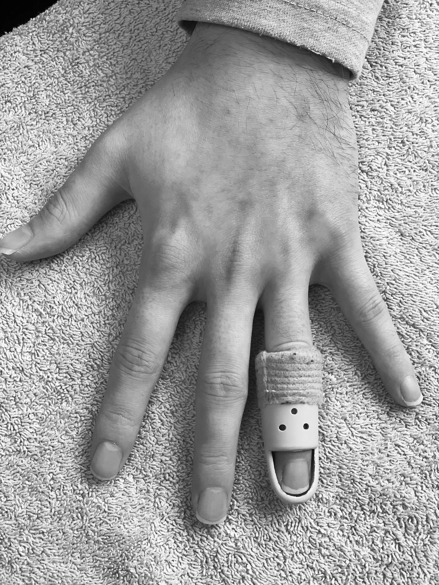 Mallet Finger Treatment and Recovery — North Shore Hand Therapy