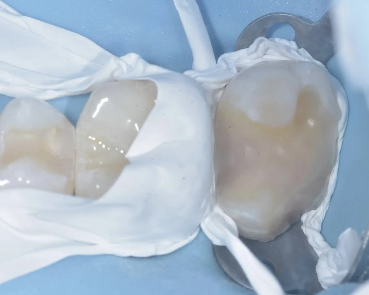 The Hybrid Layer (HL) - The Essential Bond in Restorative Dentistry ...