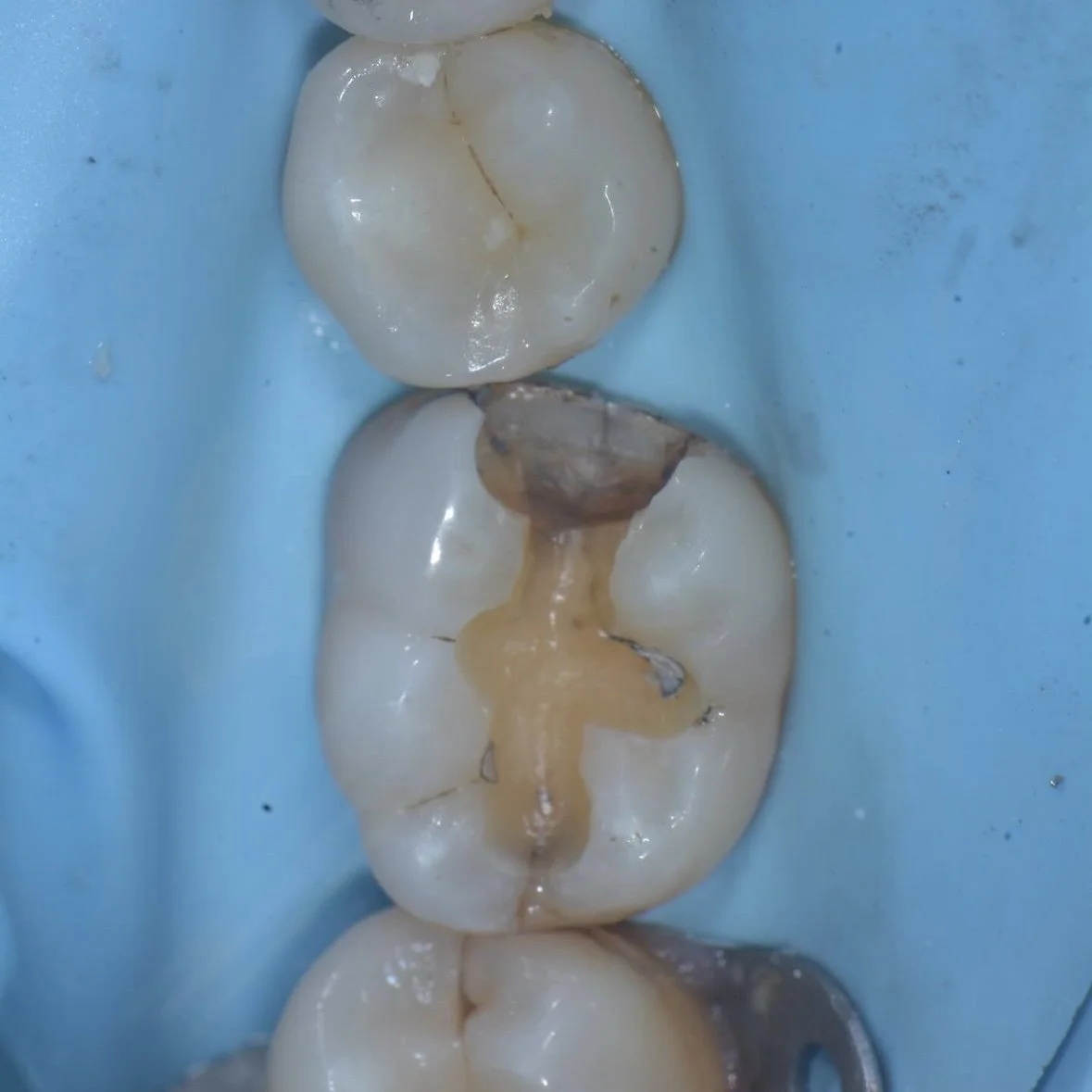 Crown Alternatives for Cracked Teeth — Alleman Center of Biomimetic ...