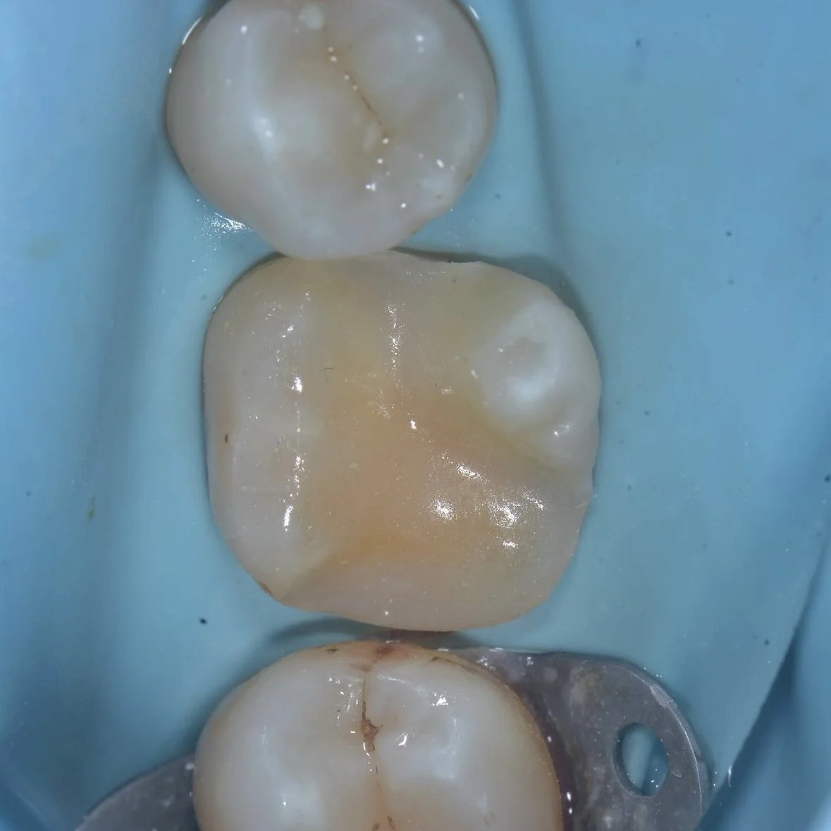 Crown Alternatives for Cracked Teeth — Alleman Center of Biomimetic ...