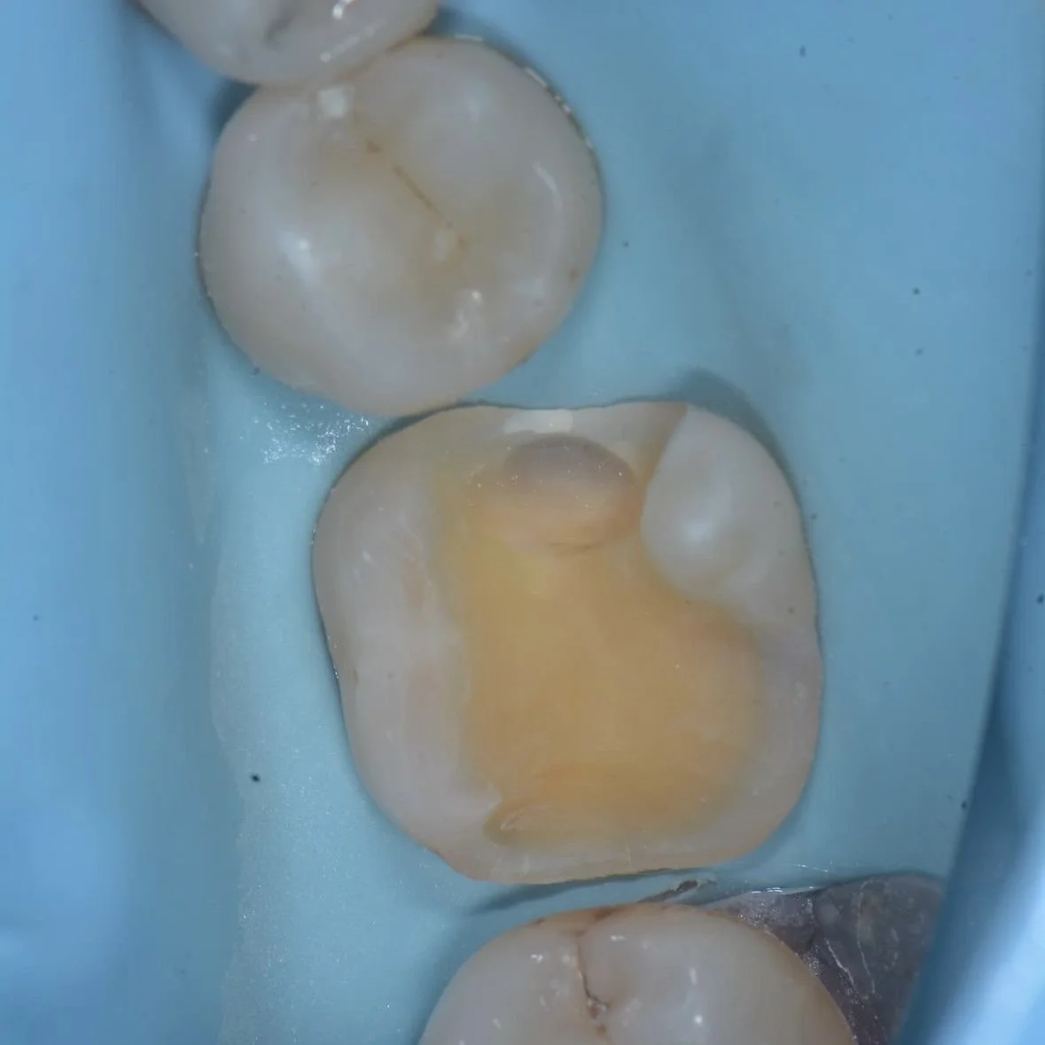 Crown Alternatives for Cracked Teeth — Alleman Center of Biomimetic ...