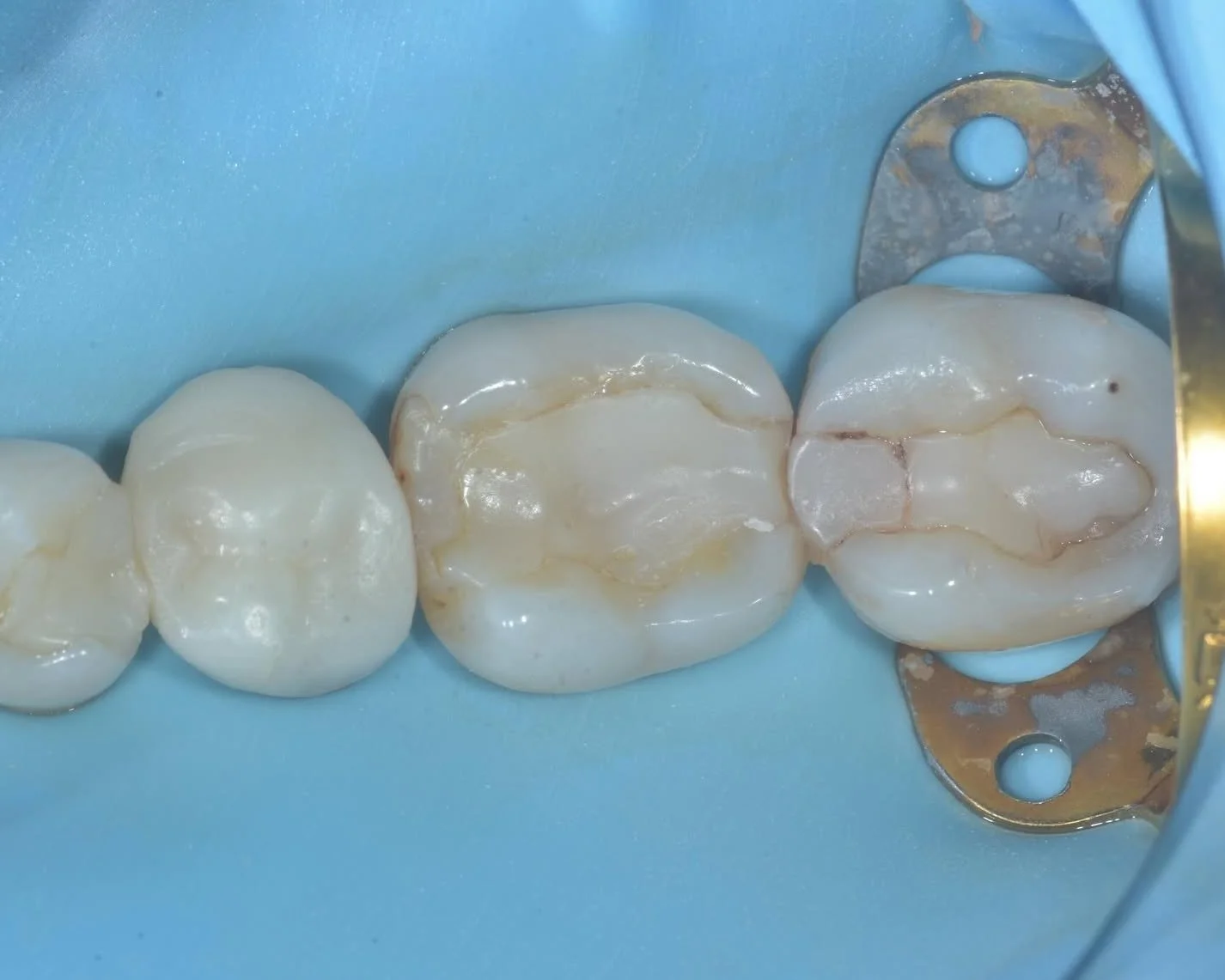Is Biomimetic Dentistry Worth It? — Alleman Center of Biomimetic Dentistry