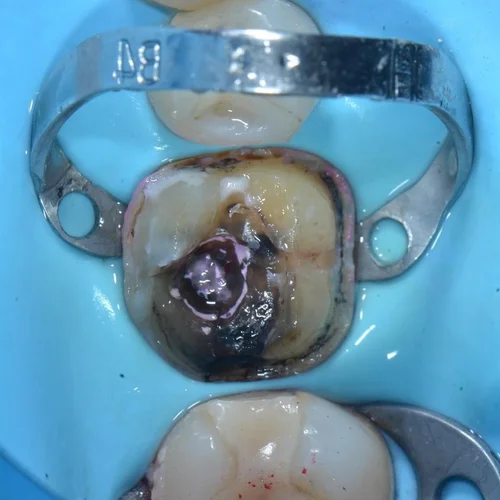 Is Biomimetic Dentistry Worth It? — Alleman Center of Biomimetic Dentistry