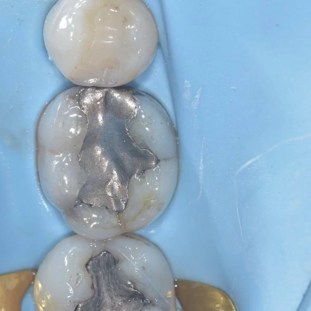 Horizontal Cracks in Teeth — Alleman Center of Biomimetic Dentistry