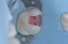 Understanding & Treating Deep Cavities — Alleman Center of Biomimetic ...