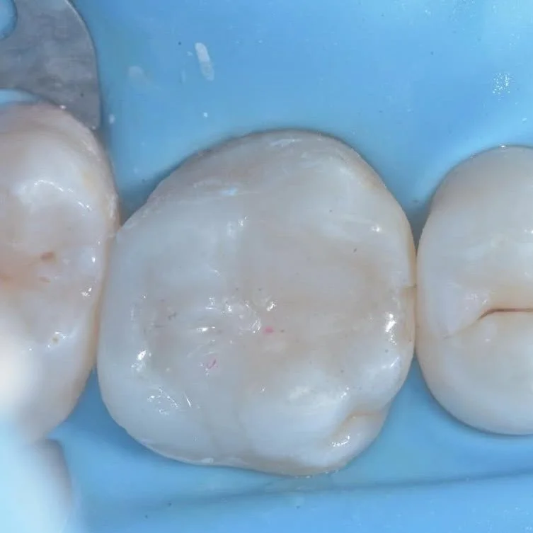 Cracks in Anterior Teeth — Alleman Center of Biomimetic Dentistry