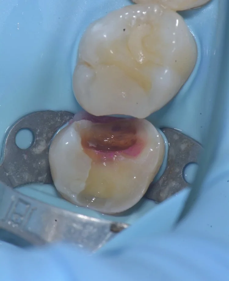 Understanding & Treating Deep Cavities — Alleman Center of Biomimetic ...