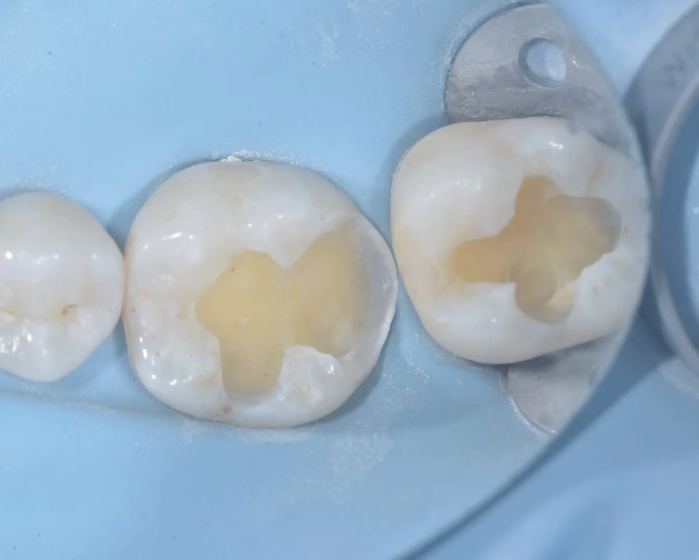 Stress-Reduced Direct Composite Restorations (SRDC) — Alleman Center of ...