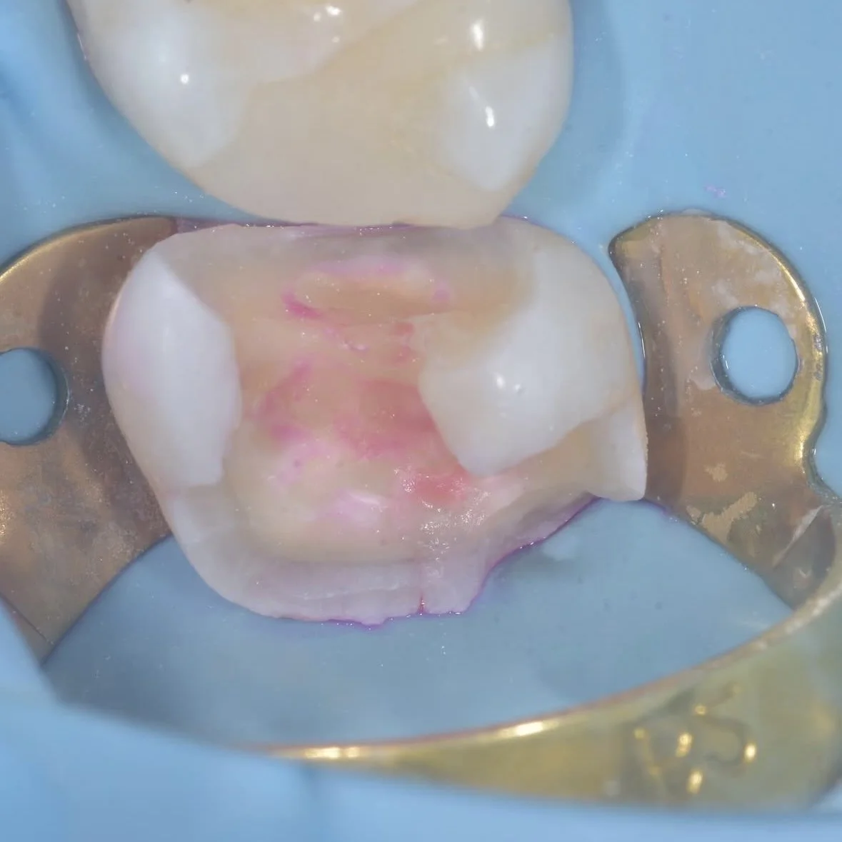 Central Stop Zone (CSZ) in Dentistry: Protecting Pulp Vitality ...