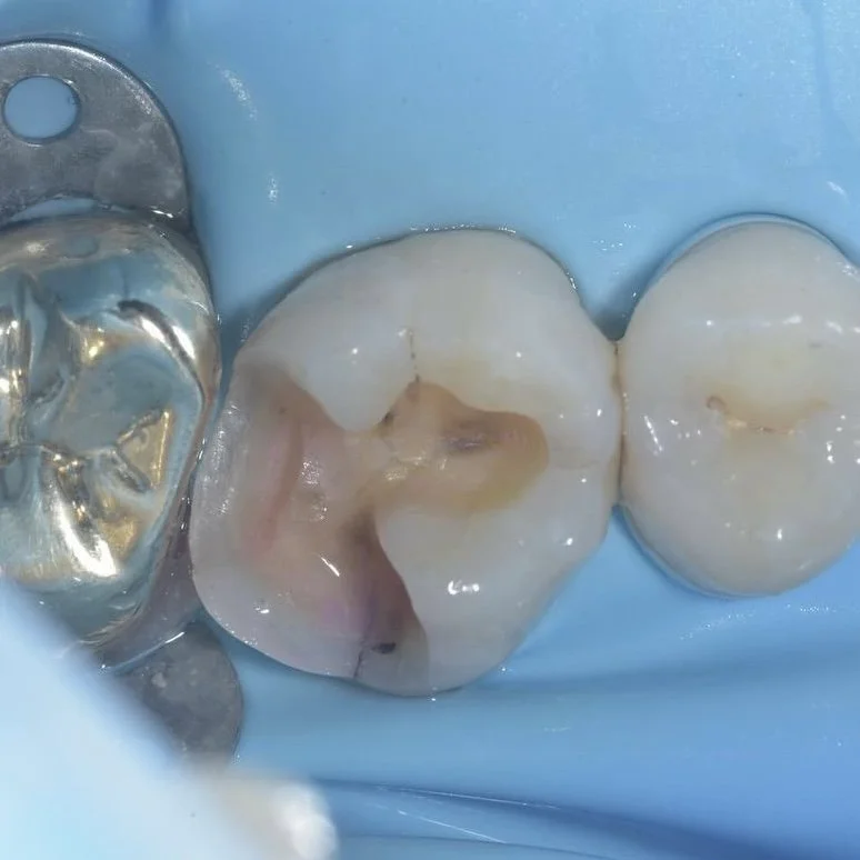 Horizontal Cracks in Teeth — Alleman Center of Biomimetic Dentistry