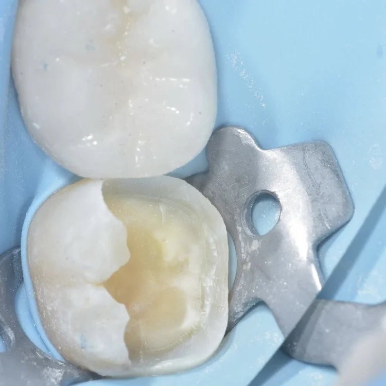Horizontal Cracks in Teeth — Alleman Center of Biomimetic Dentistry