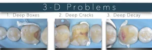 Understanding & Treating Deep Cavities — Alleman Center of Biomimetic ...