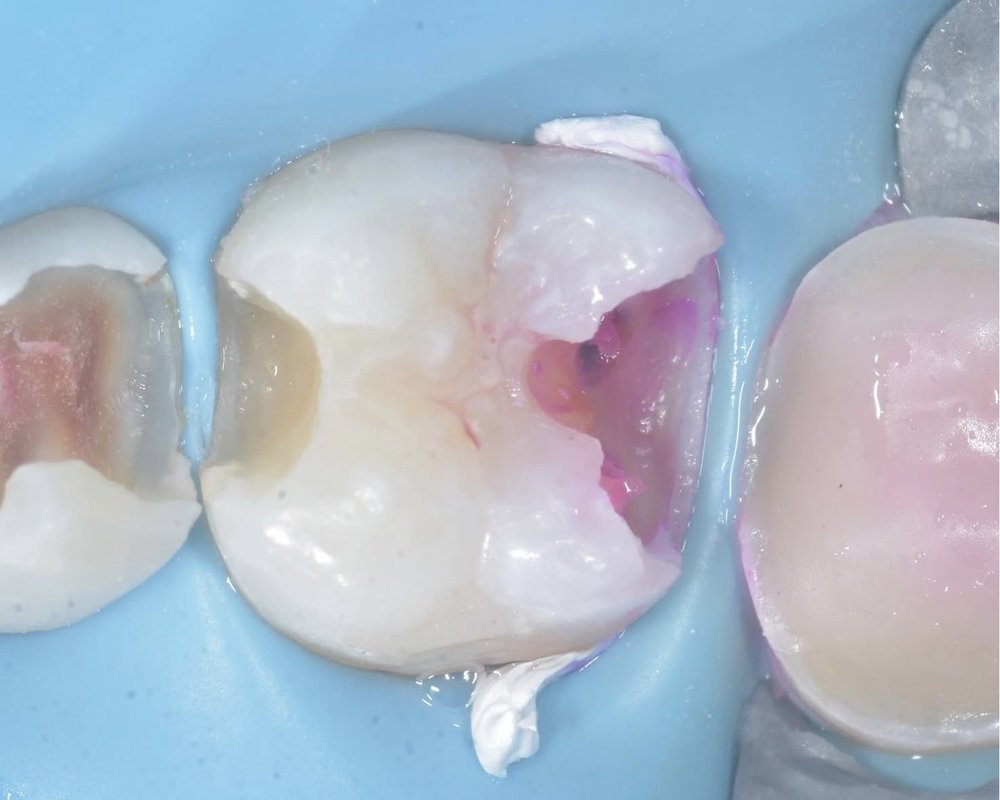 Caries Detector Dye Increase Bond Strength And Protect The Pulp — Alleman Center Of Biomimetic