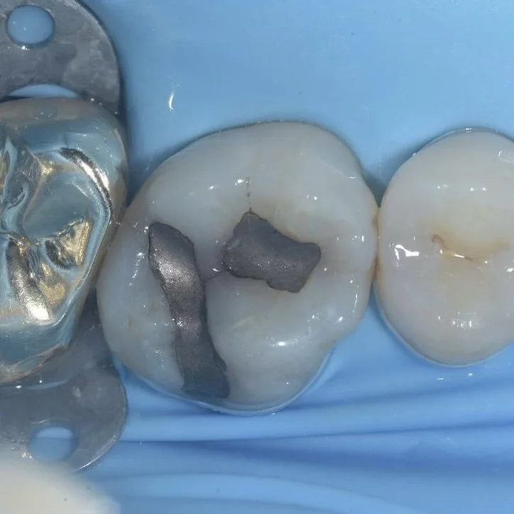 Horizontal Cracks in Teeth — Alleman Center of Biomimetic Dentistry