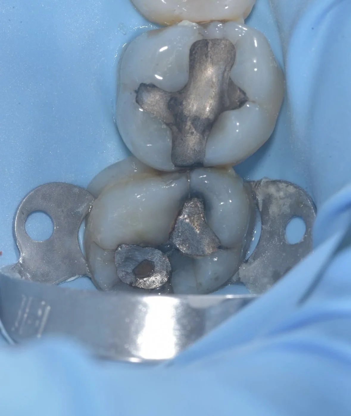 Treating Different Types of Cracks in Teeth — Alleman Center of ...