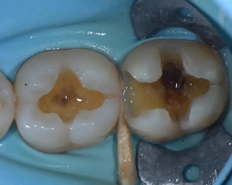 Margin Leakage in Restorative Dentistry — Alleman Center of Biomimetic ...