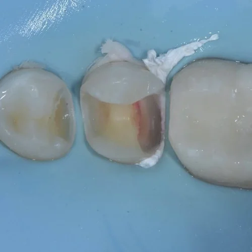 Rubber Dam Isolation for Improved Dental Bonding — Alleman Center of ...