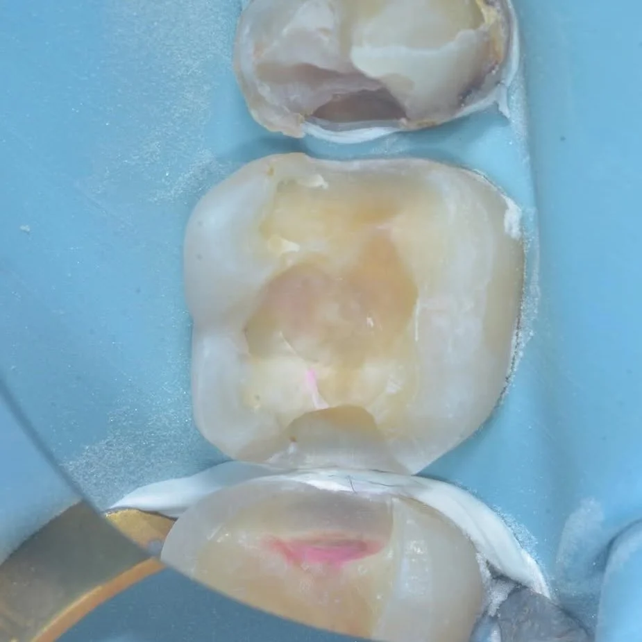 Tooth Flexure, Crack Initiation and Abfraction Lesions — Alleman Center ...