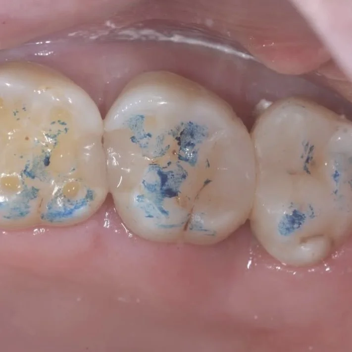 The Hybrid Layer (HL) - The Essential Bond in Restorative Dentistry ...