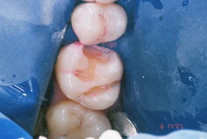 Understanding & Treating Deep Cavities — Alleman Center of Biomimetic ...
