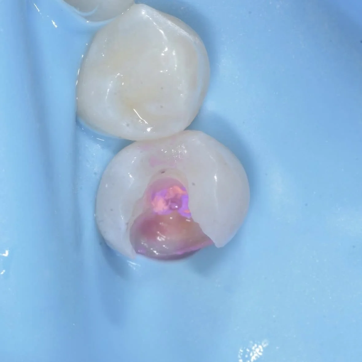 Caries Detector Dye (CDD): Increase Bond Strength and Protect the Pulp ...