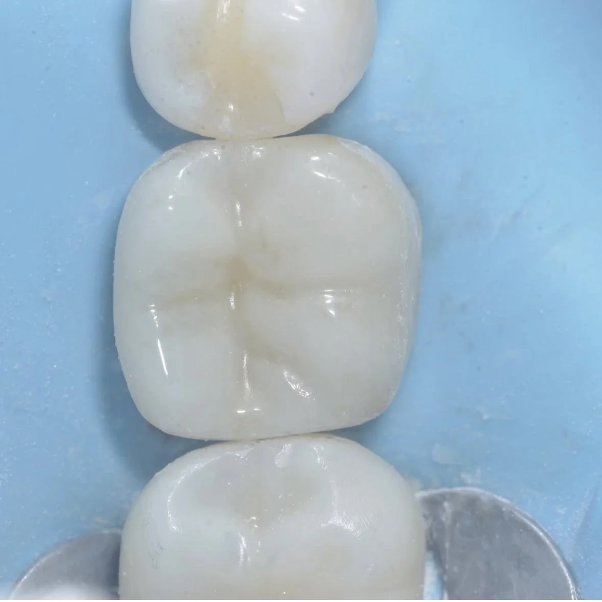 How to Choose an Enamel Replacement — Alleman Center of Biomimetic ...