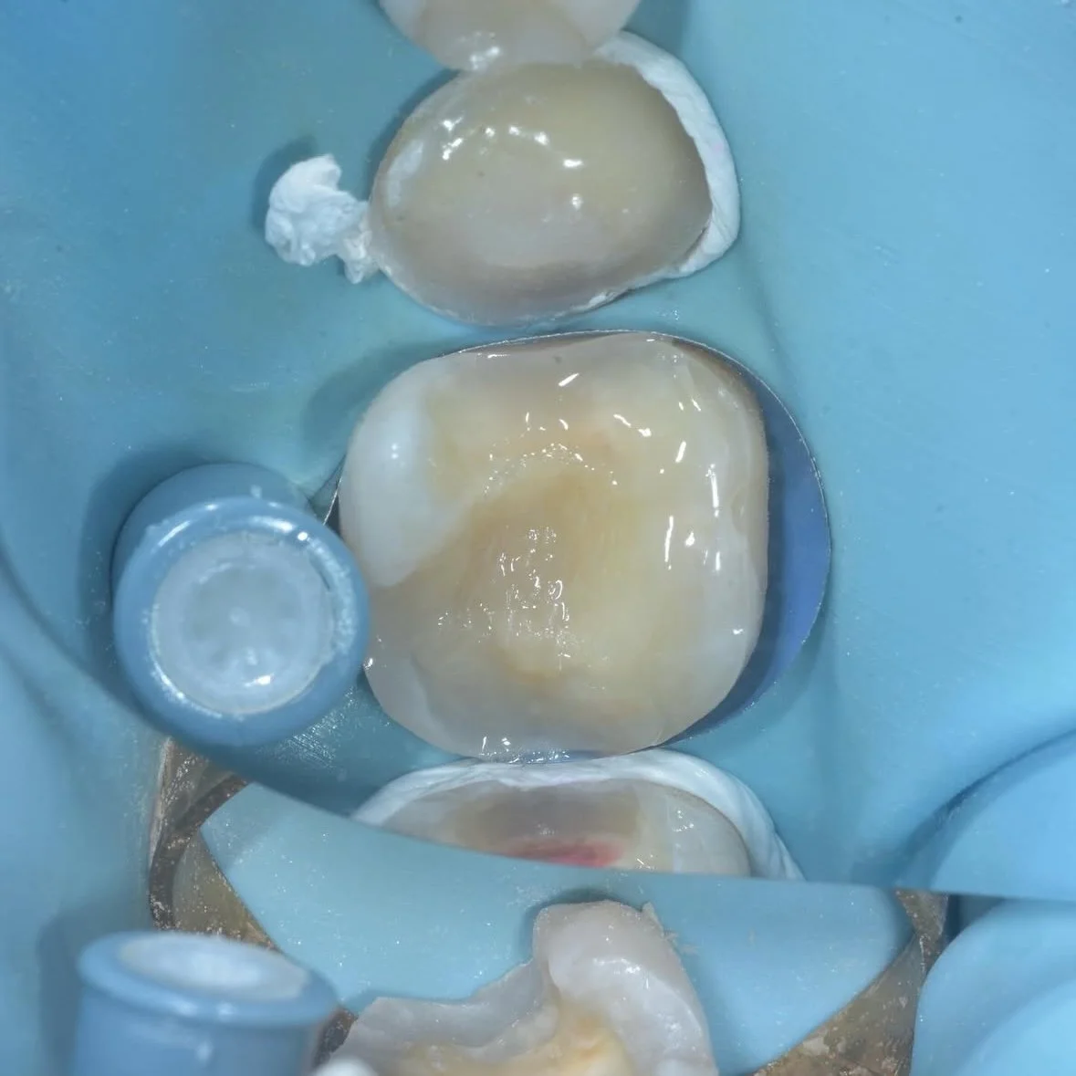 Tooth Flexure, Crack Initiation and Abfraction Lesions — Alleman Center ...