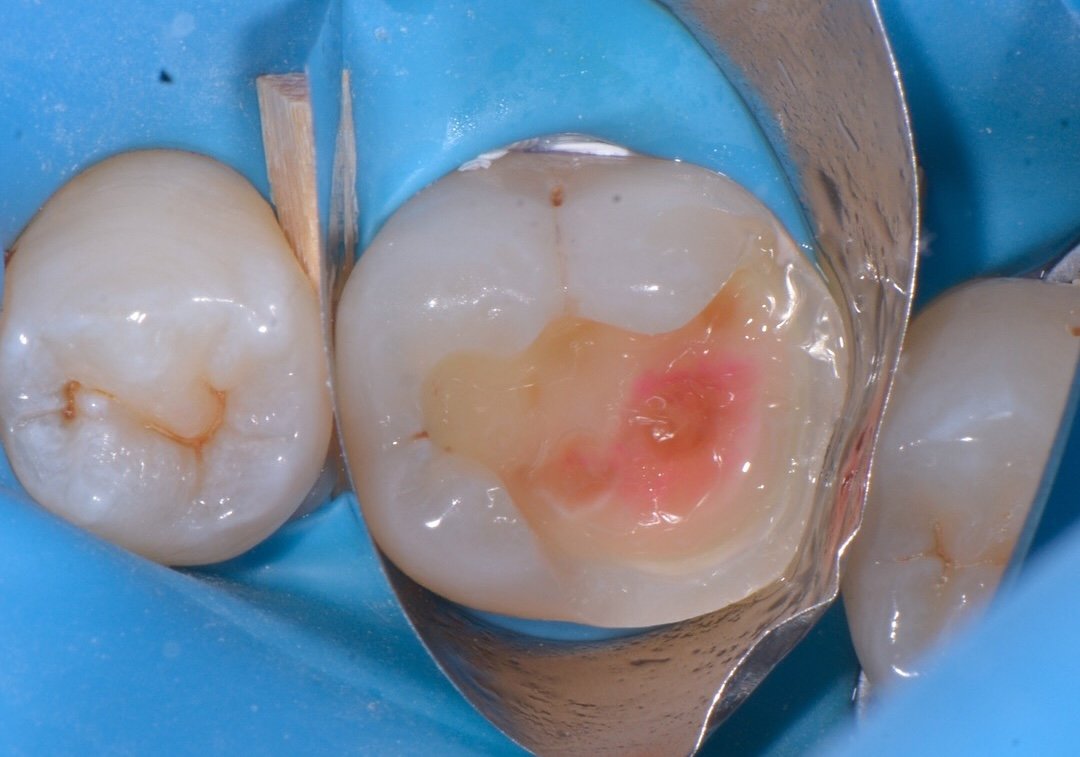 Lesson 3: Immediate Dentin Sealing and Resin Coating — Alleman Center ...