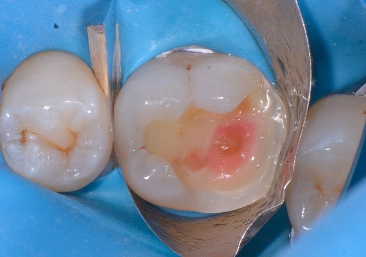 Lesson 3: Immediate Dentin Sealing and Resin Coating — Alleman Center ...
