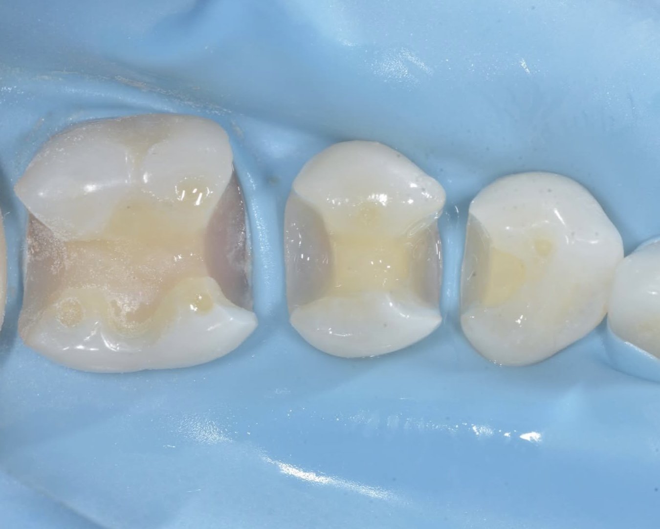 Rubber Dam Isolation for Improved Dental Bonding — Alleman Center of ...