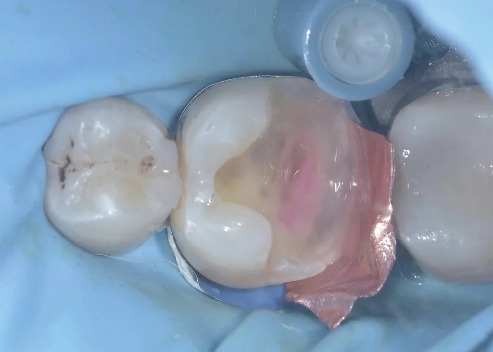 Dental Primers vs Dental Adhesives — Alleman Center of Biomimetic Dentistry