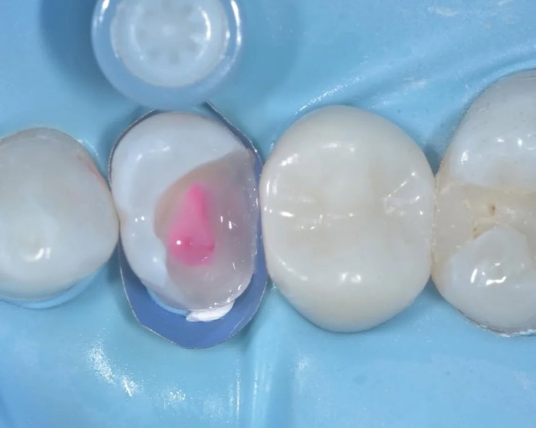 How to Seal Exposed Dentin — Alleman Center of Biomimetic Dentistry