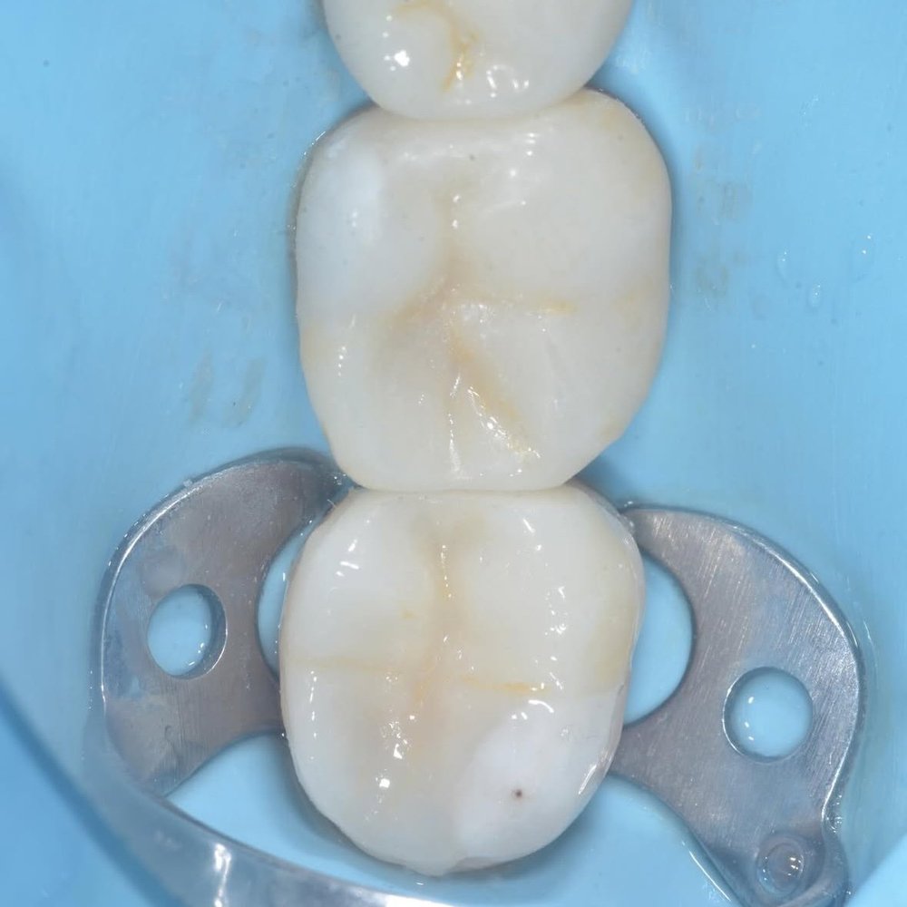 How to Choose a Dental Bonding Agent (DBA) — Alleman Center of ...