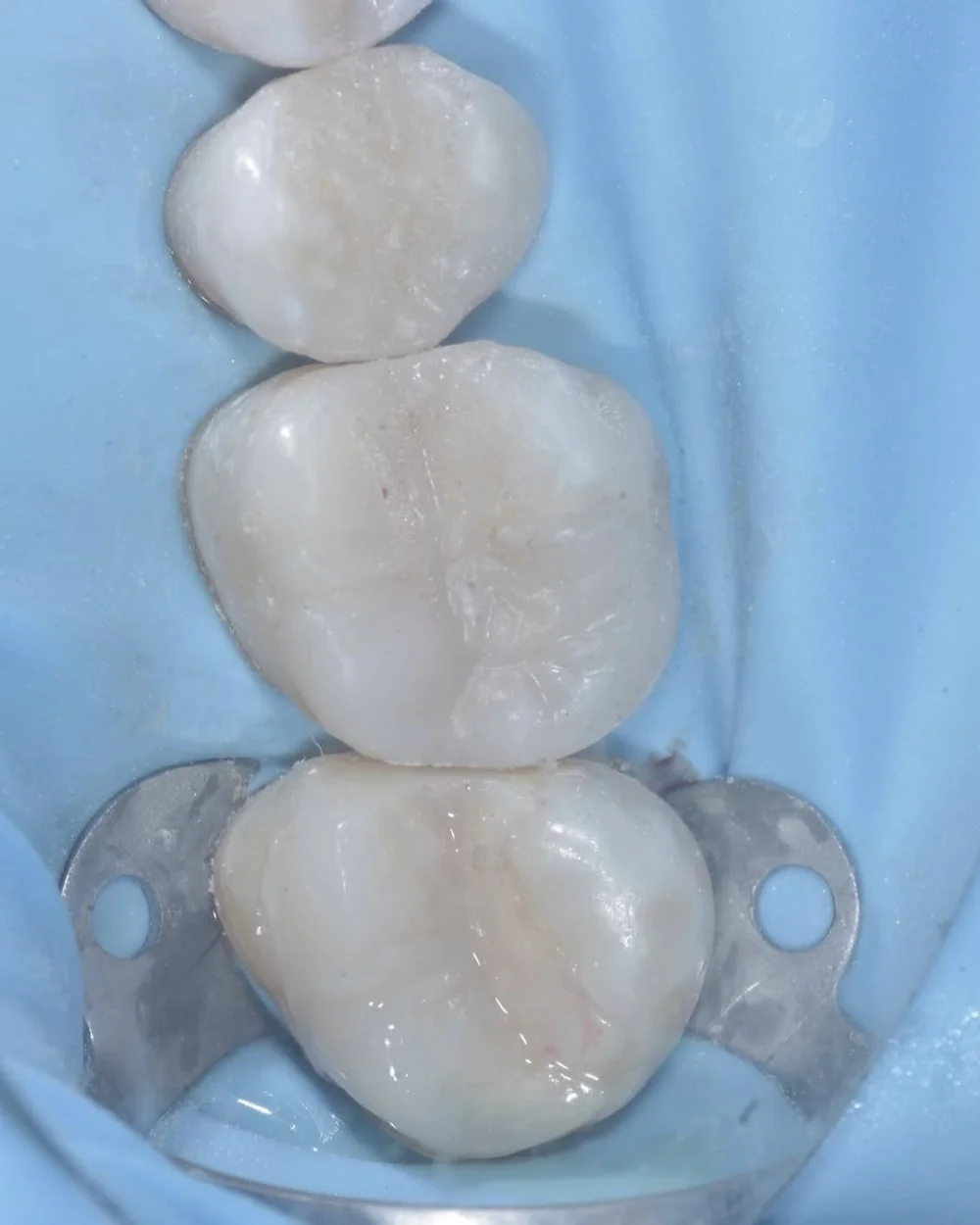 How to Choose an Enamel Replacement — Alleman Center of Biomimetic ...