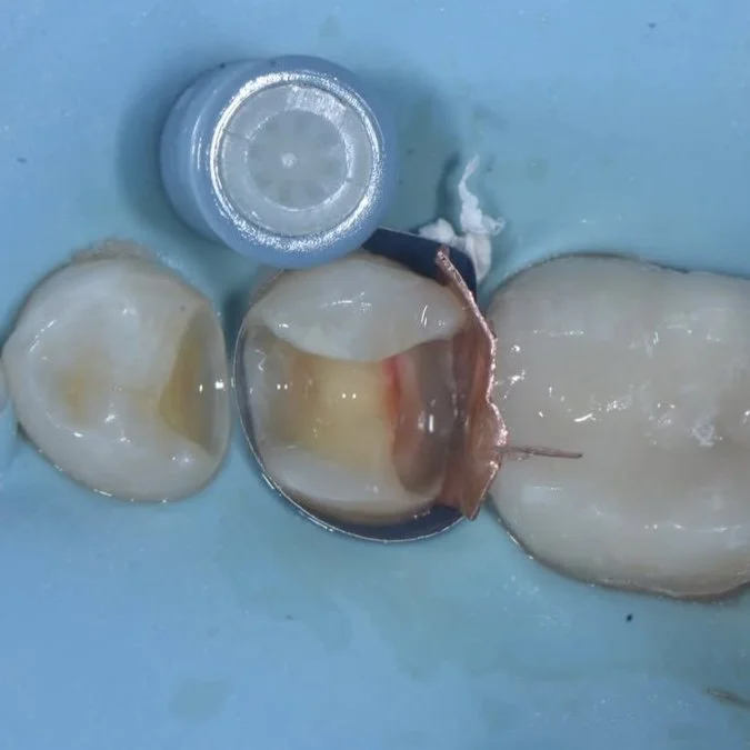 Conservative Alternatives to Crown Lengthening Surgery — Alleman Center ...