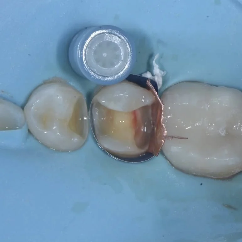 Rubber Dam Isolation for Improved Dental Bonding — Alleman Center of ...