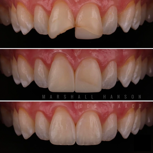 Cracks in Anterior Teeth — Alleman Center of Biomimetic Dentistry