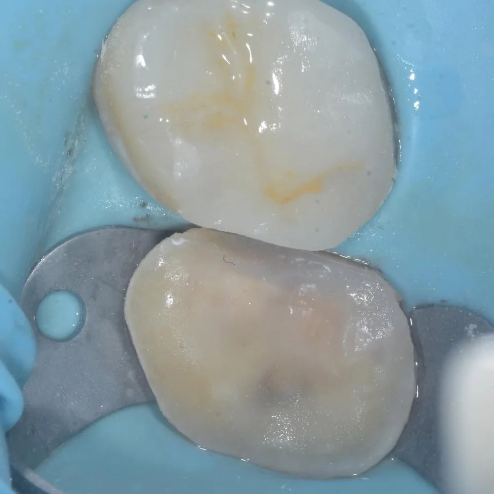 How to Seal Exposed Dentin — Alleman Center of Biomimetic Dentistry
