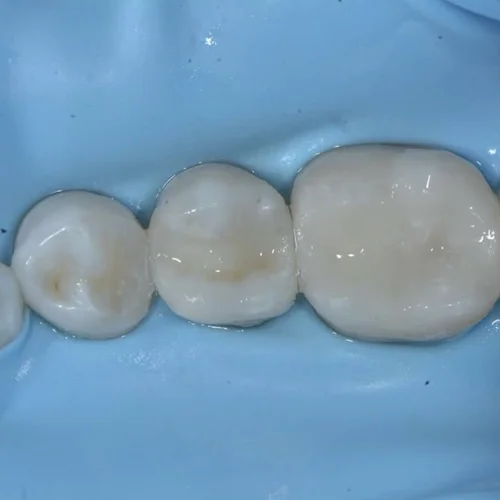 Conservative Alternatives to Crown Lengthening Surgery — Alleman Center ...